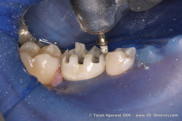 Step by Step All Ceramic Crown Preparation – 3D Dentists