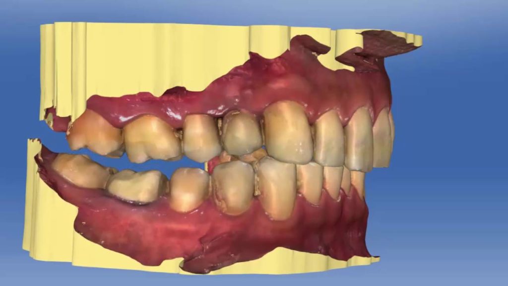 CEREC-Articulation-Animation-attachment – 3D Dentists