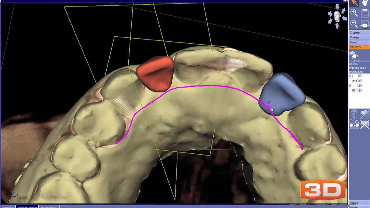 Implant-Plan-Review-Congenitally-Missing-Laterals-attachment – 3D Dentists