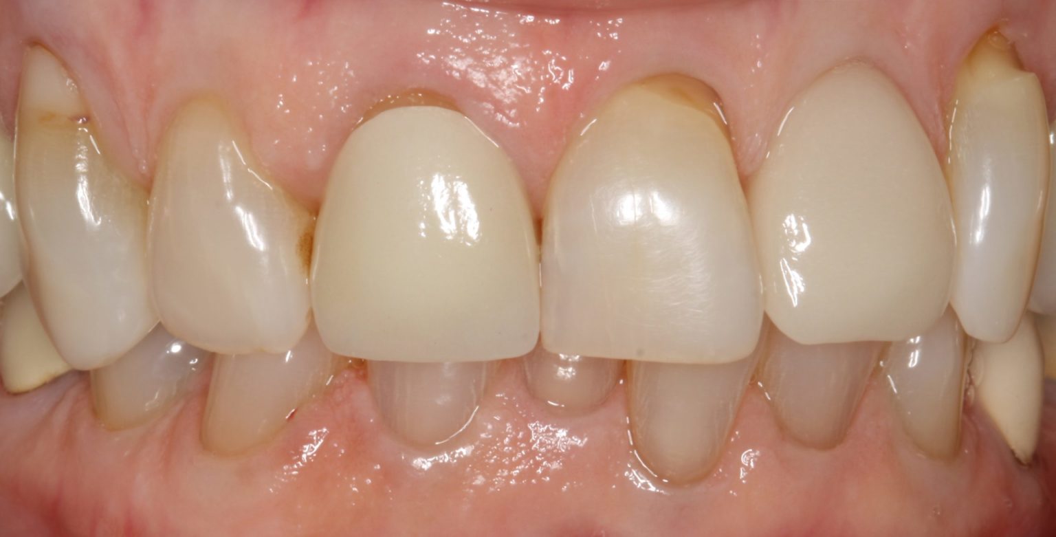 Shape Matters : What should a lateral incisor look like? – 3D Dentists