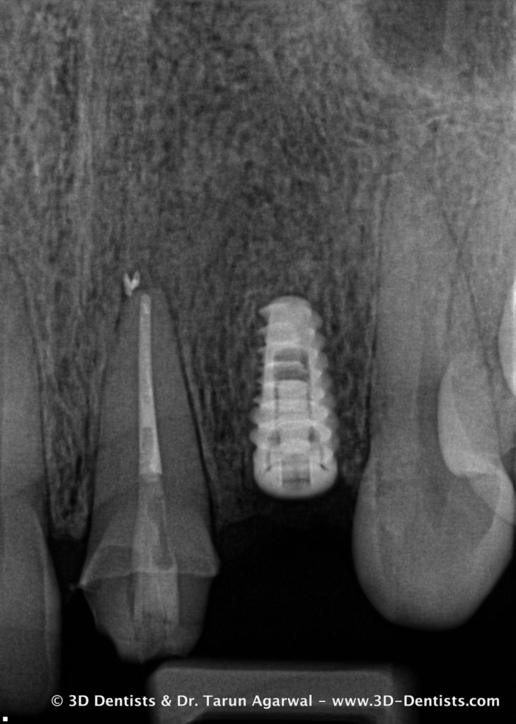 Peri-Implant Management – 3D Dentists